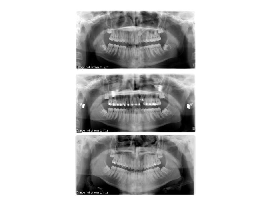 Best treatment Female Ortho Case | Dunn Orthodontics