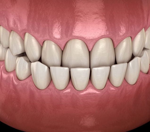 Underbite treatment in orthodontics